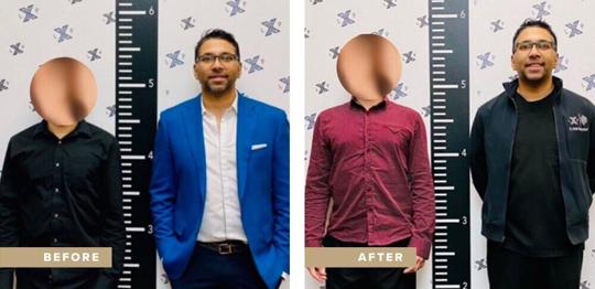 Is surgery to make you taller the new BBL for men?