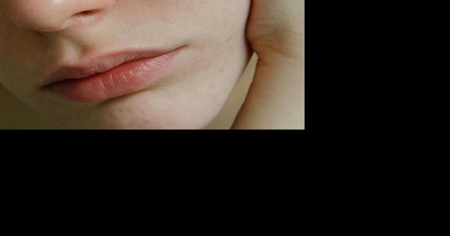 Do drugs like Ozempic and Wegovy have skin side effects?