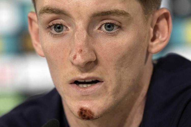 England winger Gordon escapes serious injury from bike accident during downtime at Euro 2024