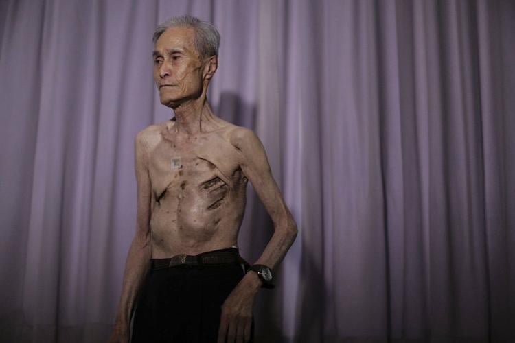 Powerful AP photos show the scars of a survivor of the Nagasaki atomic ...