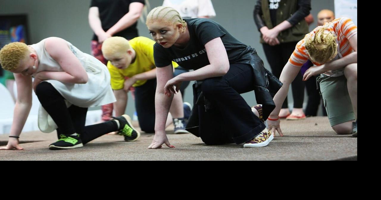 Albinism pageant in Zimbabwe joyfully breaks down prejudice