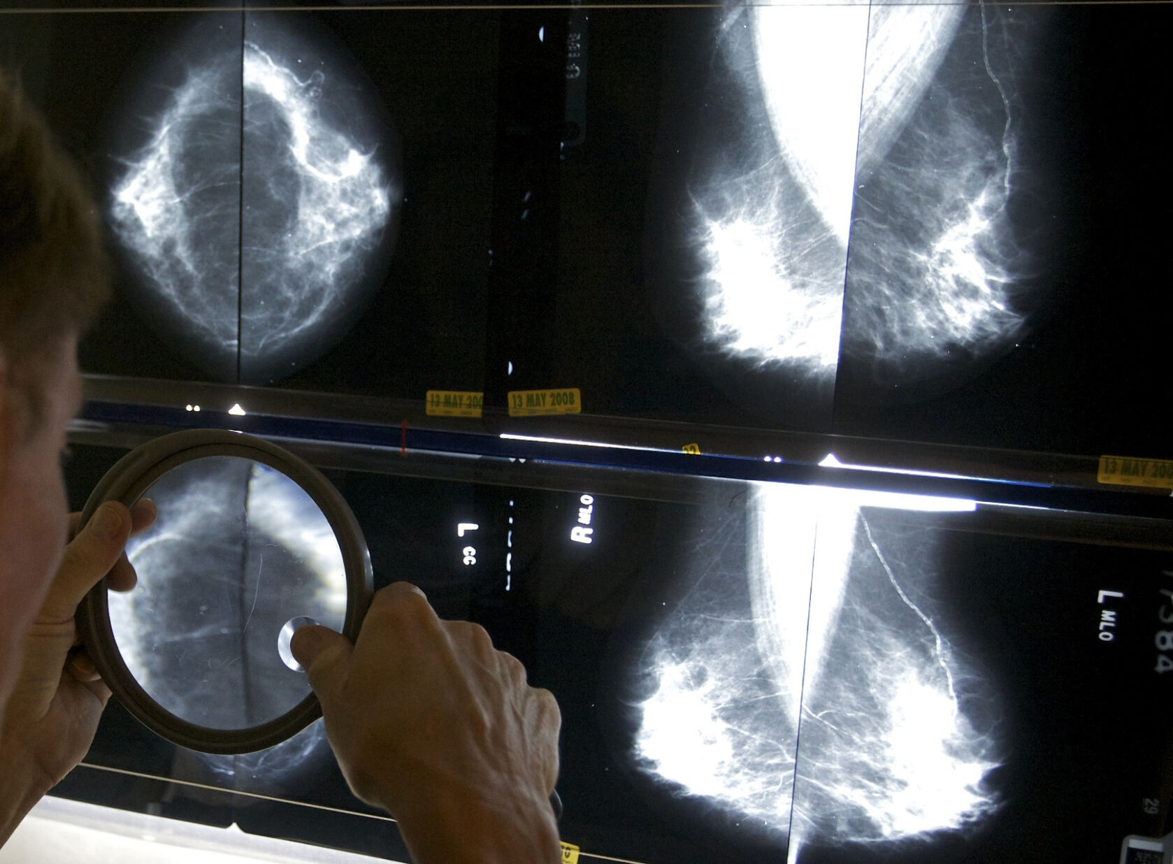 Mammograms help with early detection