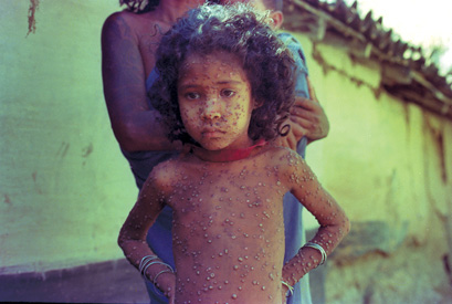 Experts debate destroying last smallpox viruses