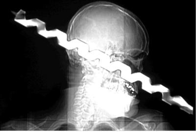 impaled through the head