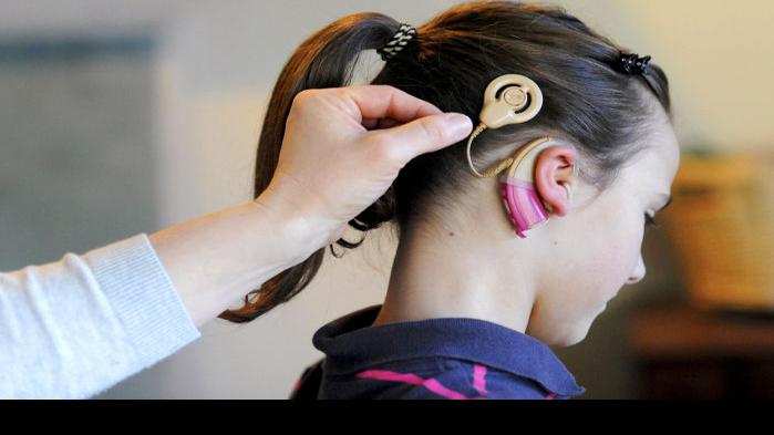Cochlear Implant | | theworldlink.com
