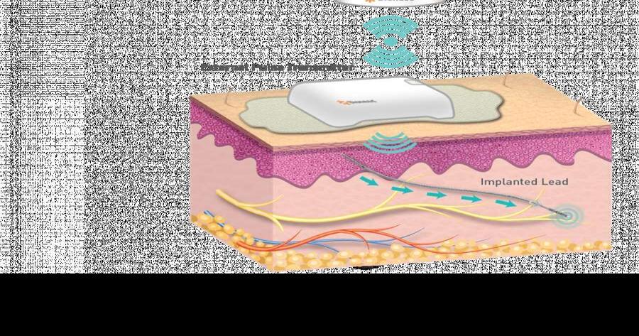 StimRouter option to combat pain | Health | times-herald.com