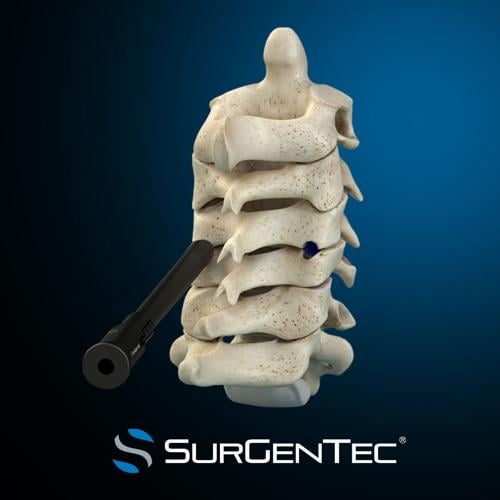 SurGenTec® Secures FDA Clearance for ION-C™ Facet Fixation System ...