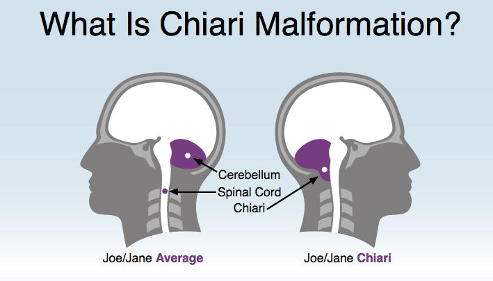 Grandmother helps raise money to battle Chiari | News | timeswv.com