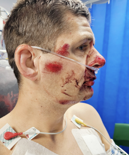 Horrific hit-and-run leaves man unable to remember his name | News ...