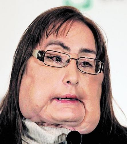 A brave new face, courtesy of a cadaver