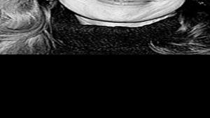 Dana Reeve, 44, dies of lung cancer