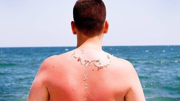 sunburn peeling back