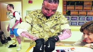 Badly burned Marine: a lesson in toughness