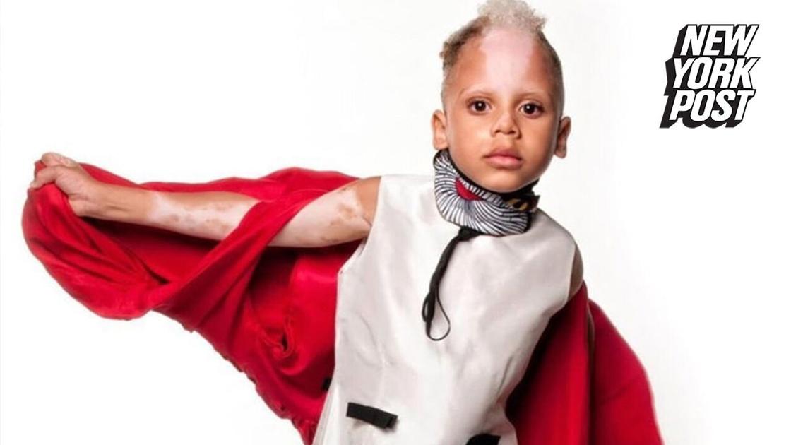 Boy with rare skin condition becomes 'supermodel'