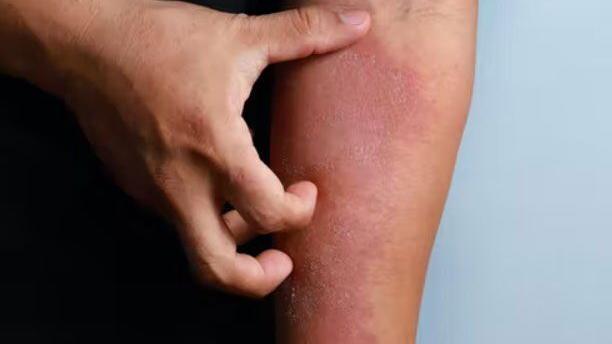What is that rash? Genetic fingerprints can help doctors better ...