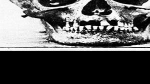 Bones seem to be from the skull of Beethoven