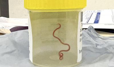 Neurosurgeon plucks live worm from woman's brain | Odd & Unusual ...