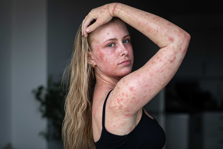 Woman left in agony after eczema cream leaves 95% of skin in pain ...