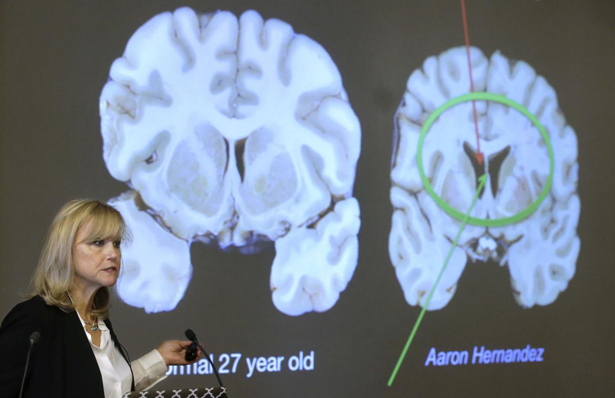 CTE research has ramifications