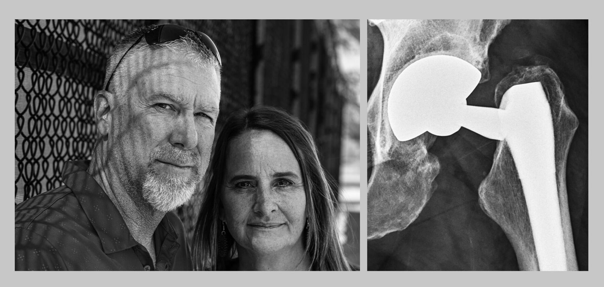 Patients Expected Profemur Artificial Hips to Last. Then They Snapped ...