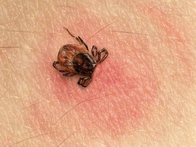 Cover Story: Tick-related ER visits surge this spring | Cover Story ...