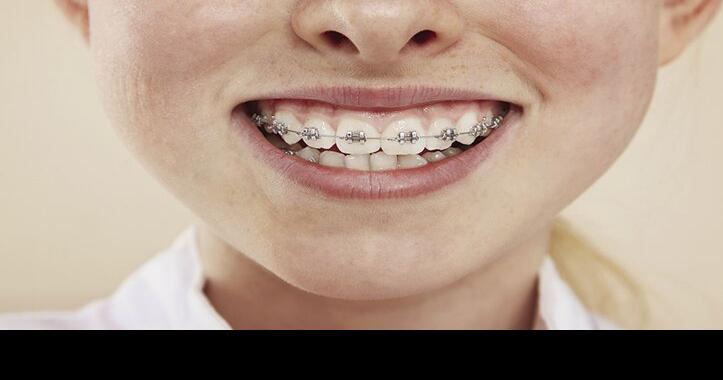 How braces move teeth | Health | willistonherald.com