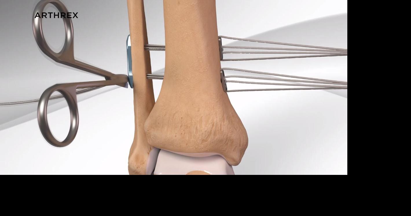 TightRope device by Arthrex leads to quicker recovery times for ...