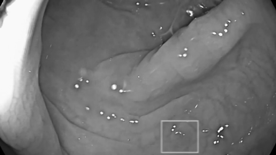 Using artificial intelligence to catch cancer in CT scans | Health ...