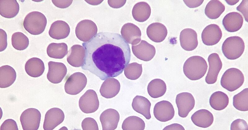 LGL Leukemia: Managing a rare form of cancer | Health & Medical ...