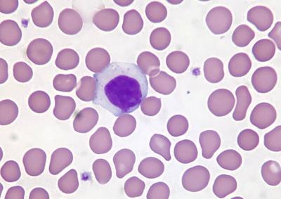 lgl leukemia