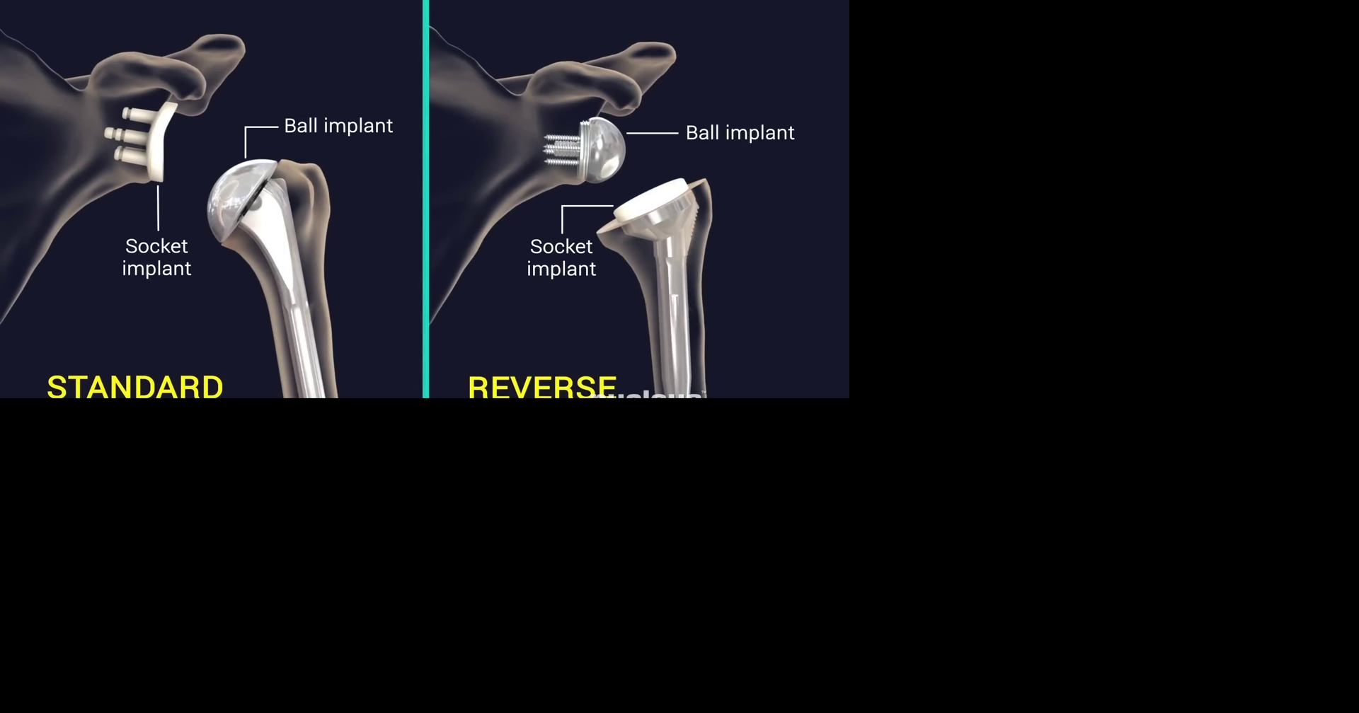 Reverse shoulder replacement offers new approach to pain management ...
