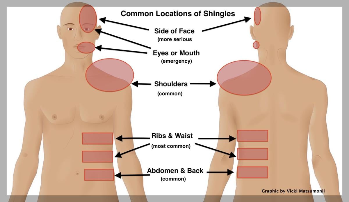 shingles in torso