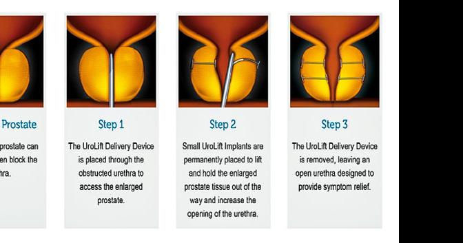 Innovative UroLift System to treat enlarged prostate now available at ...