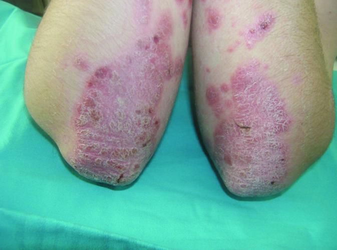 New treatments can bring relief to psoriasis sufferers | Local News for ...