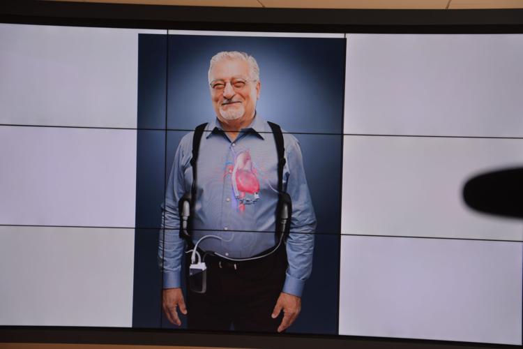 WVU Medicine first to perform life saving procedure in WV | WV News ...