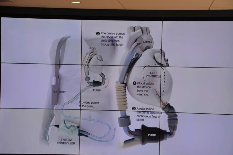 WVU Medicine first to perform life saving procedure in WV | WV News ...