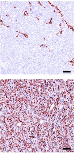Columbia scientists find gene that drives prostate cancer | Health ...